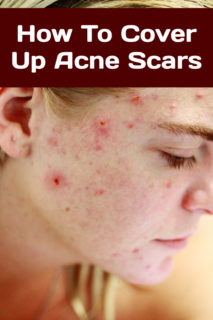 9 Helpful Tips to Cover Up Those Bad Acne Scars | Steal The Style