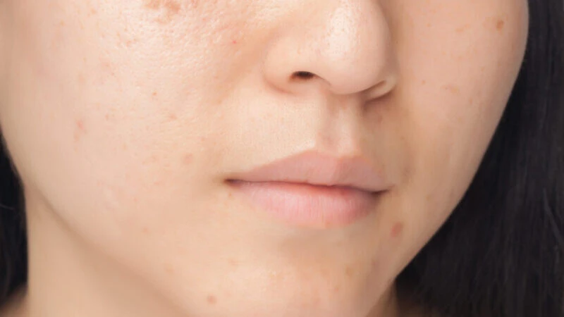 9 Helpful Tips to Cover Up Those Bad Acne Scars | Steal The Style